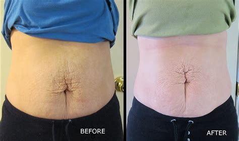 ReclaimYourCore Diastasis Recti Before And After Pics 2 Week Progress