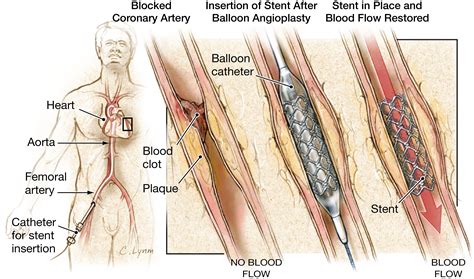 Stents To Treat Coronary Artery Blockages Cardiology JAMA JAMA