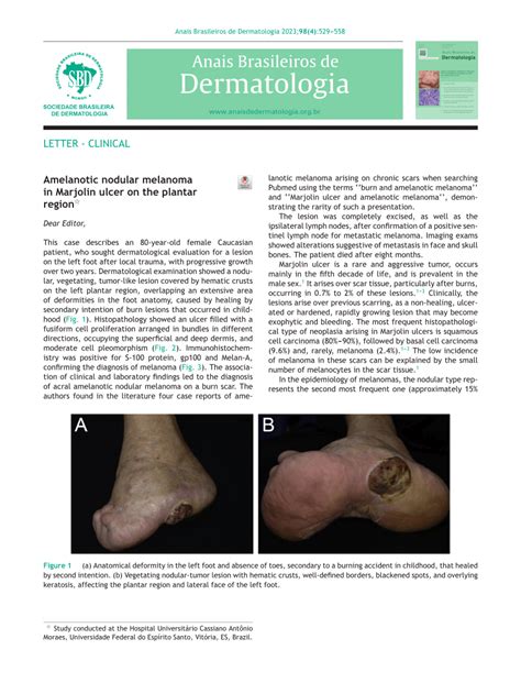 Pdf Amelanotic Nodular Melanoma In Marjolin Ulcer On The Plantar Region