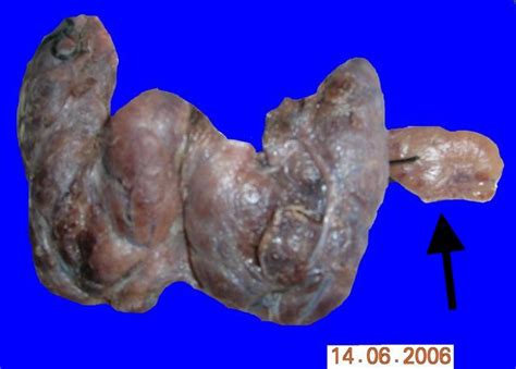 Pathology Outlines Parathyroid Adenoma