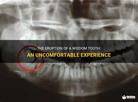 The Eruption Of A Wisdom Tooth An Uncomfortable Experience MedShun