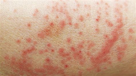 Rash On Bottom Of Buttocks