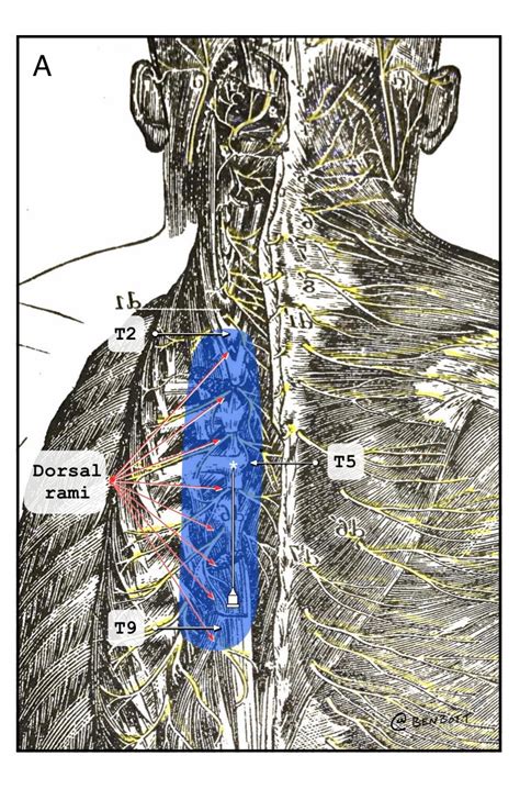 ERECTOR Highland EM Ultrasound Fueled Pain Management