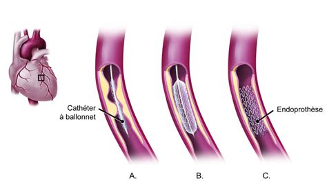 Stent Dans Le Coeur Get Images
