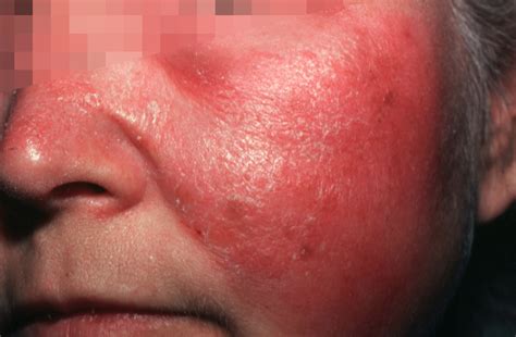 Erysipelas Medlibes Online Medical Library