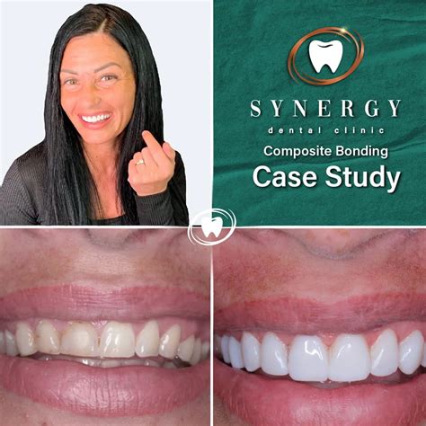 Dr Zuber Bagasi Synergy Blackpool Composite Bonding Synergy