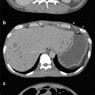 Computed Tomography CT Of The Abdomen And Pelvis Revealed