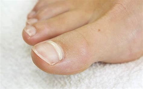 Ingrown Toenail Non Invasive Treatment The Foot Group