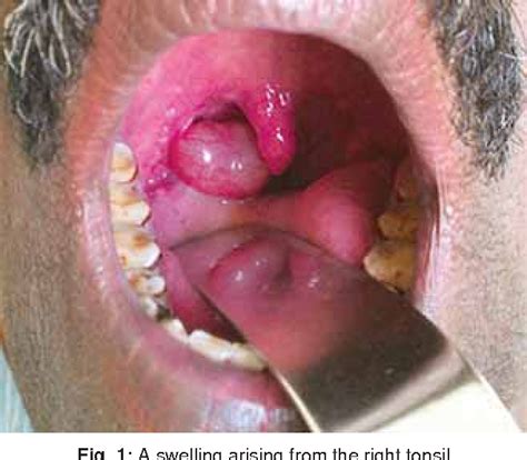 Lymphoepithelial Cysts
