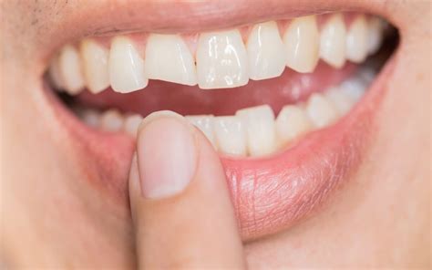 Traumatismos dentales más comunes CIO Arturo Soria