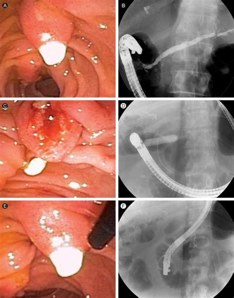 Pancreatic Pseudocyst Drainage A Visible Bulge In The Stomach B