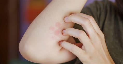 9 signes et symptômes d une carence en vitamine B6