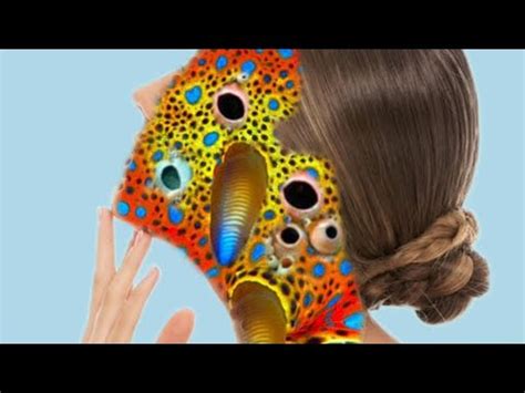 ASMR Remove Big Acne Snake Poison ASMR Treatment Animation Infected