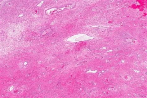 Juvenile Nasopharyngeal Angiofibroma Ottawa Atlas Of Pathology