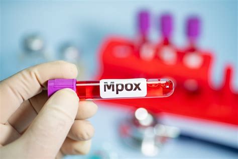 Jornal Correio Mpox OMS Aprova Primeira Vacina Para Uso Emergencial