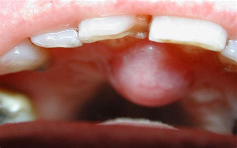 Kyste Naso Palatin Dermatologie Buccale Dr Lotfi Benslama Paris