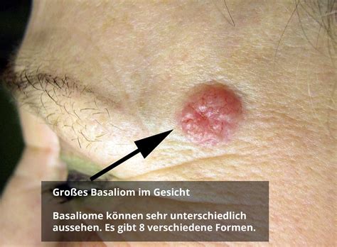 Weißer Hautkrebs Ursachen Symptome Therapie Prognose
