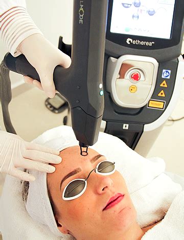 Laser Acroma Clínica Sense Clínica de Dermatologia e Cirurgia Plástica