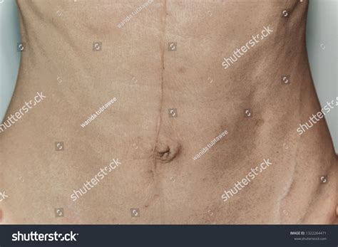 Abdominal Incisionthe Patient Abdominal Surgical Incisions Stock Photo