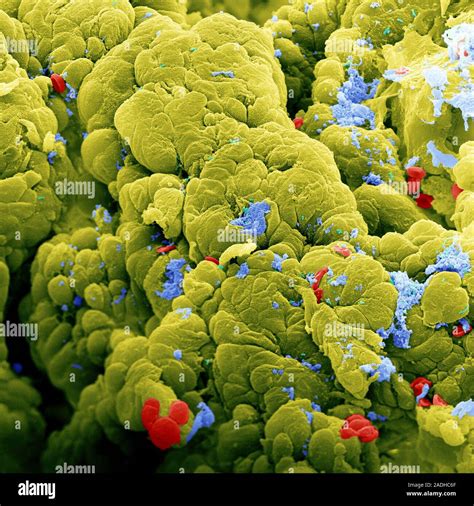 Colon Cancer Coloured Scanning Electron Micro Graph SEM Of The