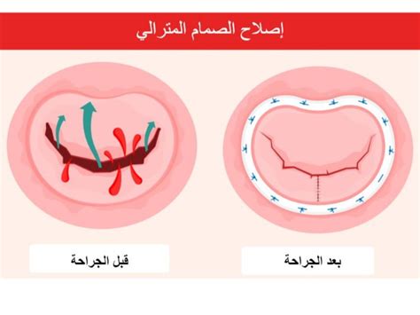 عملية اصلاح الصمام الميترالي في الاطفال موقع قلب اطفال