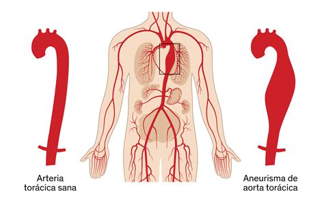 Thoracic Aortic Aneurysm ABC Medical Center