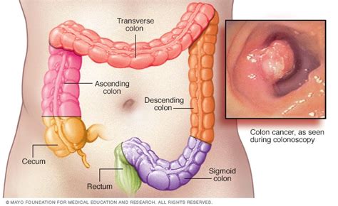 Cáncer de colon Síntomas y causas 2022