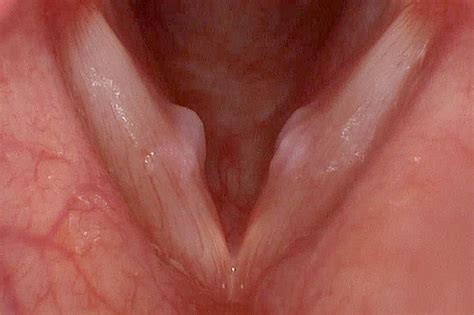 Vocal Nodules Definition Of Vocal Nodules