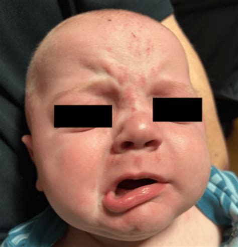 Facial Nerve Palsy In A Five Month Old Infant Cureus
