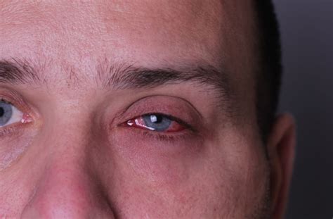 Can An Optometrist Treat Eye Infections Hercules CA