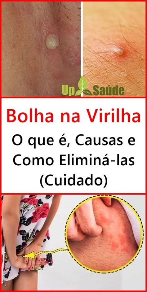 Bolha na Virilha O que é Causas e Como Eliminá las Cuidado Blog