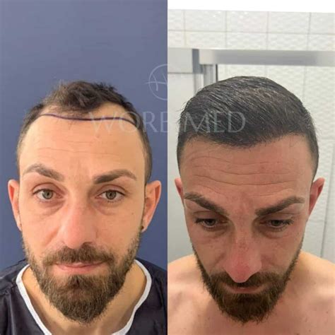 3000 Grafts Hair Transplant L Results Cost 2024