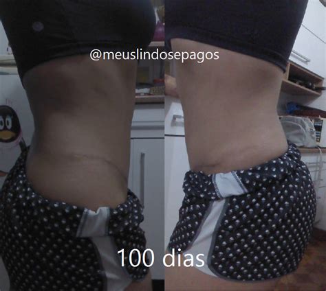 Meus Lindos e Pagos Arquivos Abdominoplastia Lipoaspiração