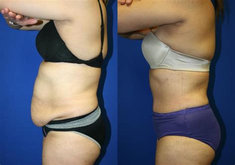Before After Tummy Tuck