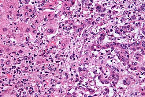 Actualités Scientifiques Médicales thelancetoncology