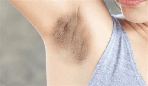 Manchas en la piel por qué me salen manchas oscuras en el cuello