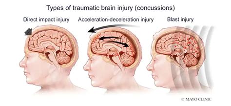 Different Types Of A TBI Horizon TBI Brain Center