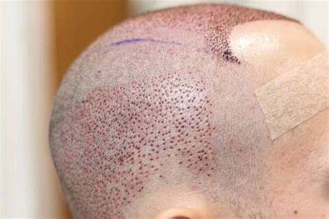 Comment Se Fait La Repousse Des Cheveux Apr S Greffe The Clinic
