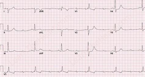 3rd Degree AVB Right Bundle Branch Block Right Axis Deviation And A