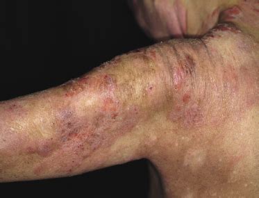 Cutaneous Adult T Cell Leukemia Lymphoma Plastic Surgery Key