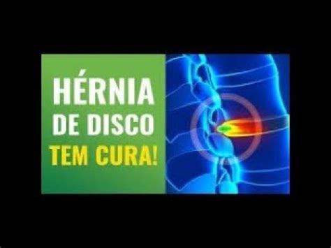 H Rnia Discal Entendendo E Dominando O Processo De Tratamento Youtube