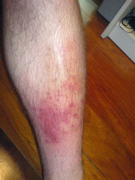 What Is The Main Cause Of Cellulitis