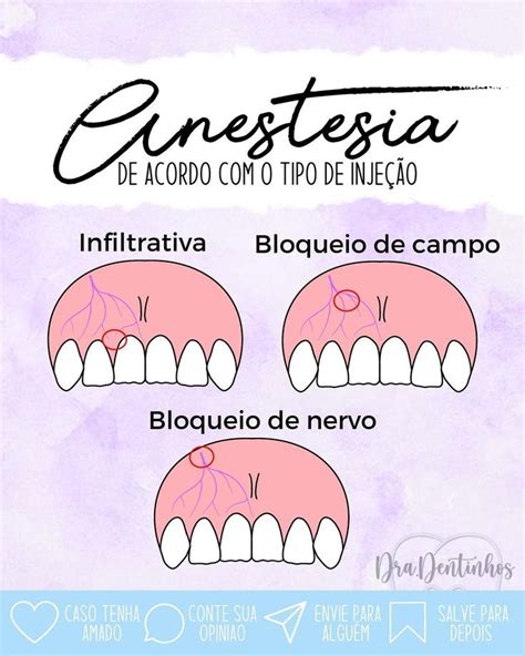 Dra Dentinhos Alices Instagram Photo T Cnicas Anest Sicas