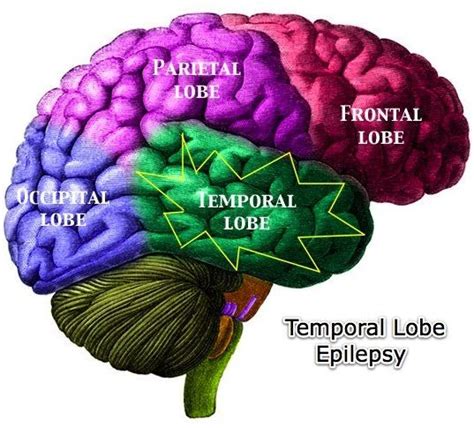 Temporal Lobe Epilepsy Epilepsy Awareness Pinterest
