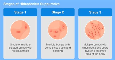 Hidradenitis Suppurativa Center