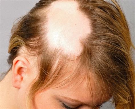 Alopecia feminina o que é como influencia na autoestima da mulher