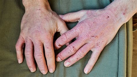 What Is Dyshidrotic Eczema Symptoms Causes Diagnosis Off