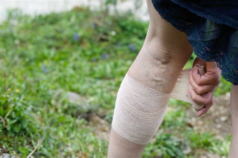 Everything You Need To Know About Venous Ulcers Vein Centre