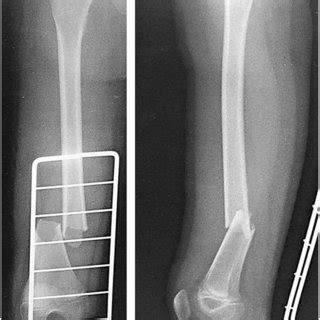 Preoperative Radiographs Showing A Noncomminuted Fracture With A
