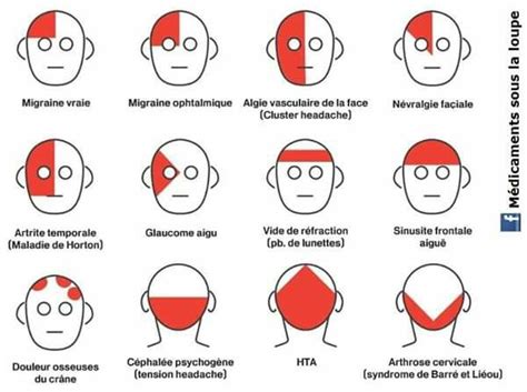 Pin by Sz Csilla on izom váz in 2024 Natural remedies for migraines